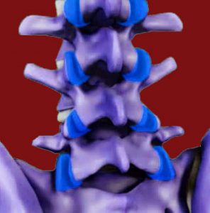 Facet Hypertrophy - Facet Joint Pain